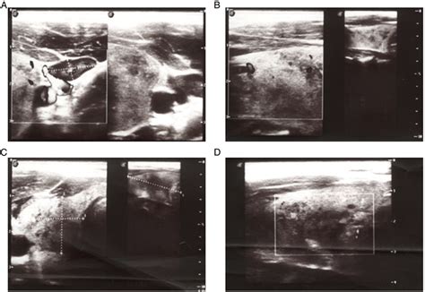 The Thyroid Glands Left Lobe In A Transverse Left Side An Enlarged