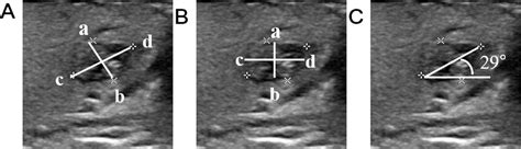 The At Measured By The Two Different Methods Of Nodular Goitres That