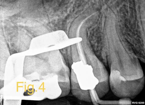 Enjoy Minimally Invasive Endodontics With Laser Activated Irrigation Pure Practical Endodontics