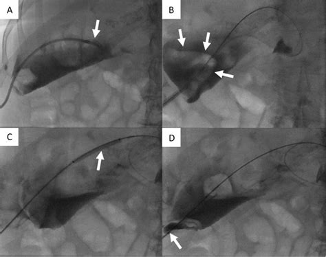 Thinking Ahead Gallbladder Intussusception Following Transperitoneal