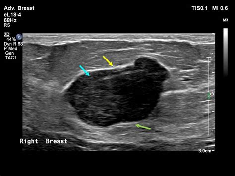 Atlas Of Breast Cancer Early Detection