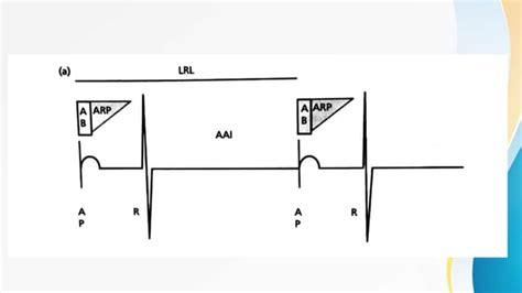 Permanent Pacemaker Cycle Length Managent Ppt Free Download
