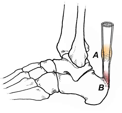 The Ideal Exercises For Managing Insertional Achilles Injuries Human Locomotion