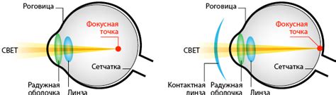 Линзы для астигматизма, очки и лазерная коррекция глаз
