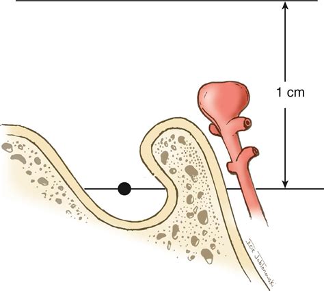 Surgical Management Of Terminal Basilar And Posterior Cerebral Artery