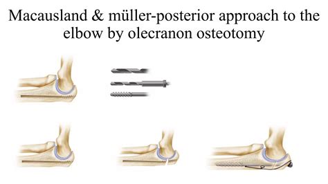 Posterior Approach To Elbow Pptx