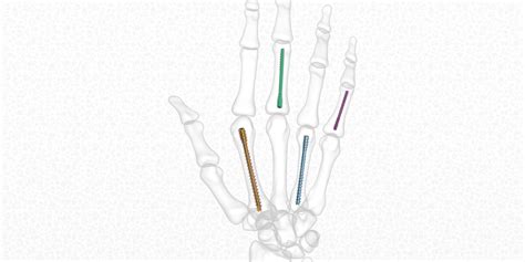 Threaded Hand Nail Skeletal Dynamics