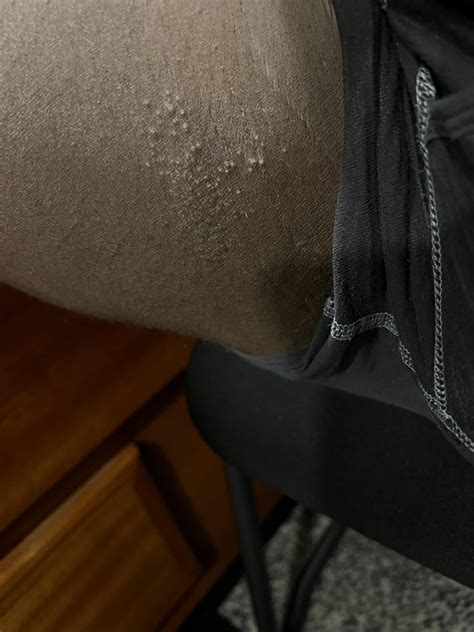 Help So I Had This Rash Pop Up Of Nowhere No Sex In About 4 Or 5
