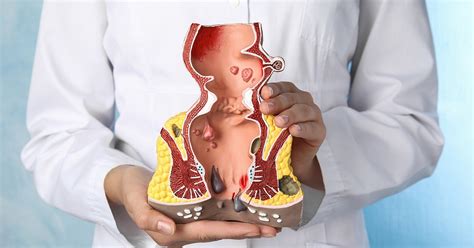 Anal Fissure Surgery Recovery General Surgery Livasa Hospitals