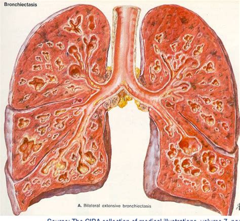 Pathophysiology Bronchiectasis Flashcards Quizlet