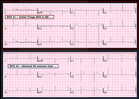 Dynamic Reversible Ischemic T Wave Inversion Mimics Wellens All Trops Negative Dr Smith