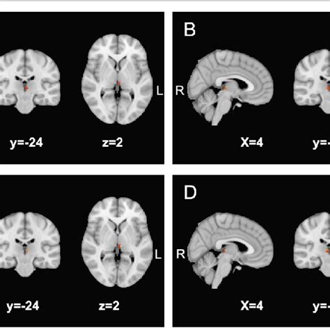 Altered Habenula Sn Functional Connectivity Maps Altered Resting State Download Scientific