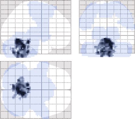 General Connectivity Increase In Cerebellum And Brainstem After