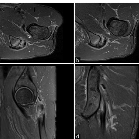 Anatomy Of Hamstring Origin The Conjoint Tendon Is Formed For Long