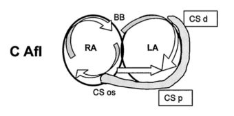 Atrial Flutter LITFL ECG Library Diagnosis
