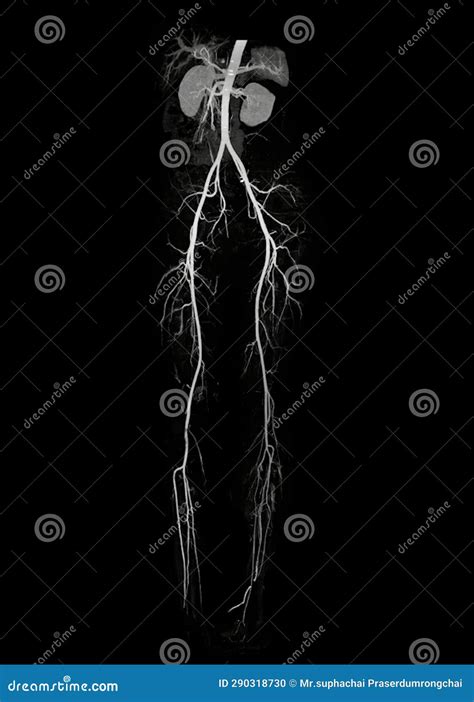 Cta Femoral Artery Run Off Showing Femoral Artery For Diagnostic Acute Or Chronic Peripheral