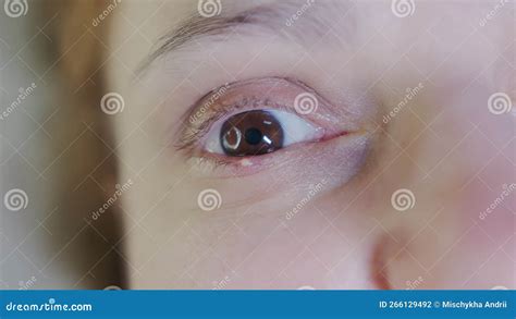 Close Up Of A Woman Eye Stye Red Eye Lid With Onset Of Stye Infection Staphylococcal Bacteria