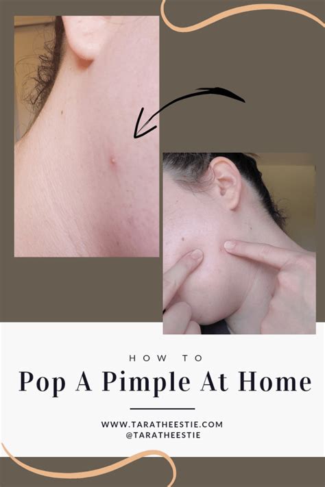 How To Pop A Pimple Correctly From A Licensed Esthetician Blog Taratheestie