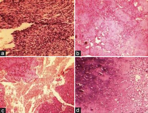 Atypical Presentation Of Osteosarcoma A Case Report Indian Journal