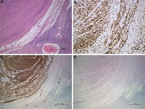 Histopathological Features Of Ovarian Leiomyomas [image] Eurekalert Science News Releases
