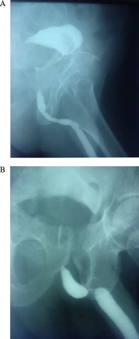A Retrograde Urethrogram Showing Ripple Of Incomplete Bulbar Urethral