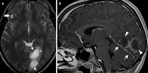 Tumefactive Multiple Sclerosis In A 13 Year Old A Axial T2 Weighted