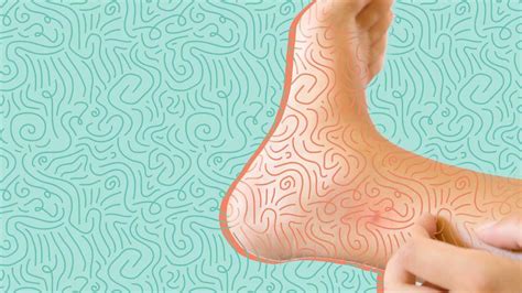 What Is Hookworm An Infectious Disease Expert Explains What You Need