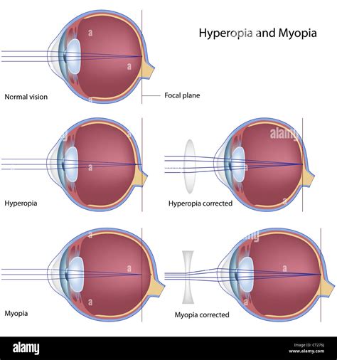 Myopia Diagram