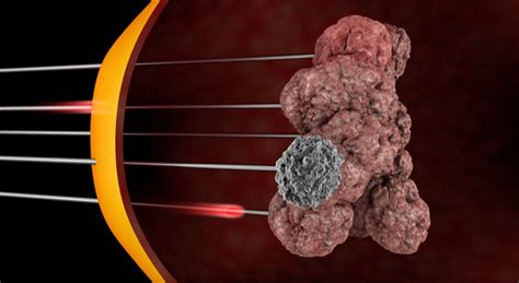 Ny Behandling Av Prostatacancer Interstitiell Fotodynamisk Terapi