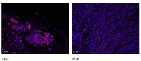 Clinicopathological Analysis Of MiRNA Expression In Breast Cancer Tissues By Using MiRNA In Situ