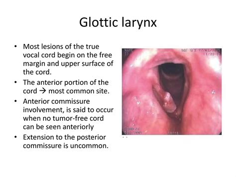 Laryngeal Cancer Management Pptx