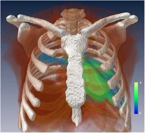 3d Volume Rendering Of Significant Clusters Of Bed Differences Between