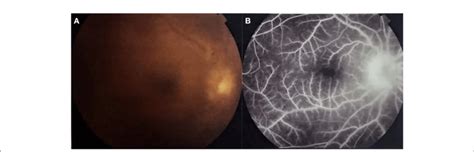 Figure E Color Photo And Fundus Fluorescein Angiography Ffa Of A