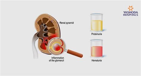 Glomerulonephritis Diagnosis And Treatment