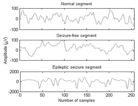 Seizure Eeg Waves