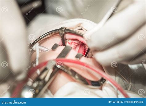 Hands Of A Dentist Doctor Closeup The Operation To Eliminate The