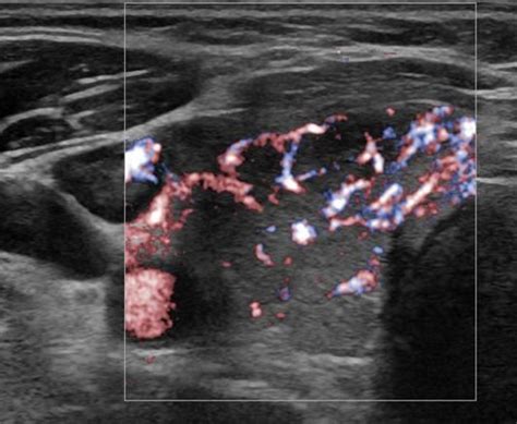Head And Neck 41 Thyroid Gland Case 414 Thyroiditis And Diffuse