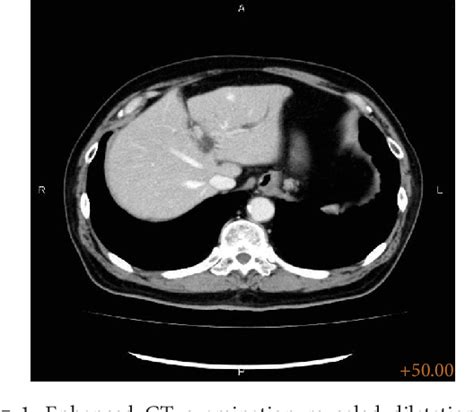 Figure 1 From Pure Laparoscopic Left Hemihepatectomy For Hepatic Peribiliary Cysts With Biliary