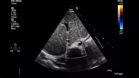 Segmental Analysis Of Heart Anatomy Pptx Heart And Cardiovascular