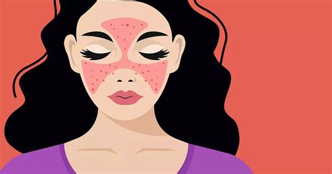Lupus Rash Vs Rosacea Pictures Symptoms And How To Tell The