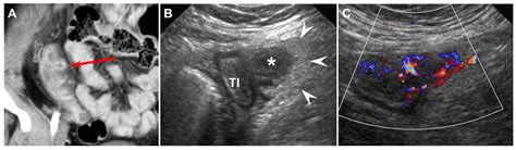 Terminale Ileum Echografie Full Article Impact Of High Resolution