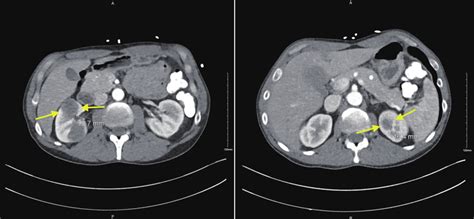 Contrast Enhanced Ct Imaging With Yellow Arrows Depicting Multiple