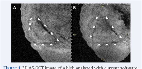 Figure 1 From Trabeculectomy Bleb Assessment Via Three Dimensional