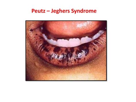 cutaneous manifestations of internal malignancies pptx skin and