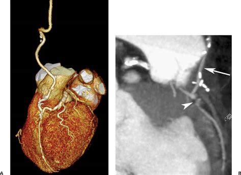 Bypass Grafts Radiology Key Bypass Grafts Radiology Key