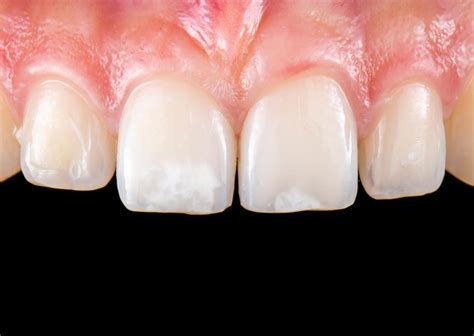 Enamel Hypocalcification Causes Symptoms And Treatment