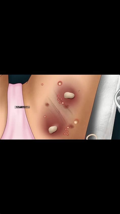 Animeasmr ‎شما با جوش های صورتتون چیکار می‌کنید؟ برای دیدن کلیپ های