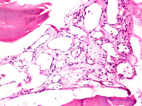 Pathology Outlines Hemangioma