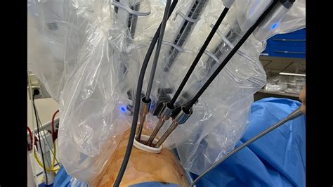 Unedited Uniportal Fully Robotic Anatomic Segmentectomy S6 Left And Hybrid Robotic S6 Right