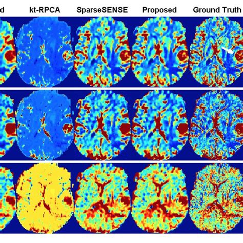 Perfusion Parameter Maps Cbf Cbv Mtt Of Subject 1 Resulting From